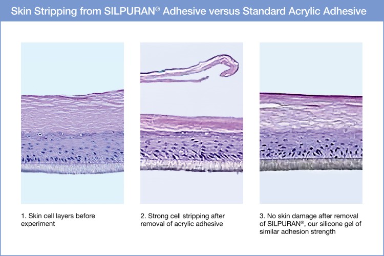 Scar care with WACKER - Wacker Chemie AG